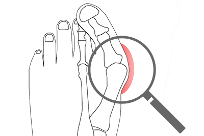 Dem Hallux Valgus entgegentreten | Ratgeber HausschuhExperte