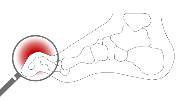 Informationen zum Hammerzeh | Ratgeber HausschuhExperte