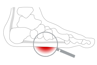 Plattfuss | Ratgeber HausschuhExperte