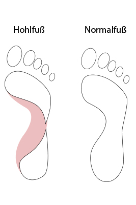 Das richtige Schuhwerk bei Hohlfuessen | Ratgeber HausschuhExperte