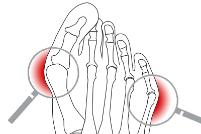 Hilfe bei Spreizfüßen | Ratgeber HausschuhExperte